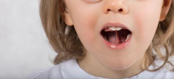 Best Laser Frenectomy Surgery For Tongue-Tie & Lip-Tie In Houston